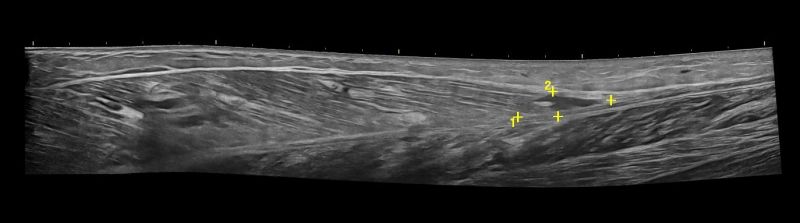 Muscles Ultrasound
